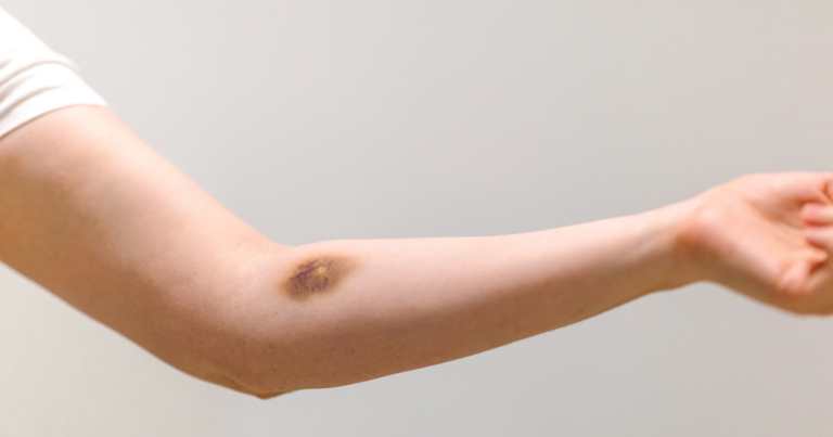 After Drawing Blood Bruising: Causes & Tips | Phlebotomy Now